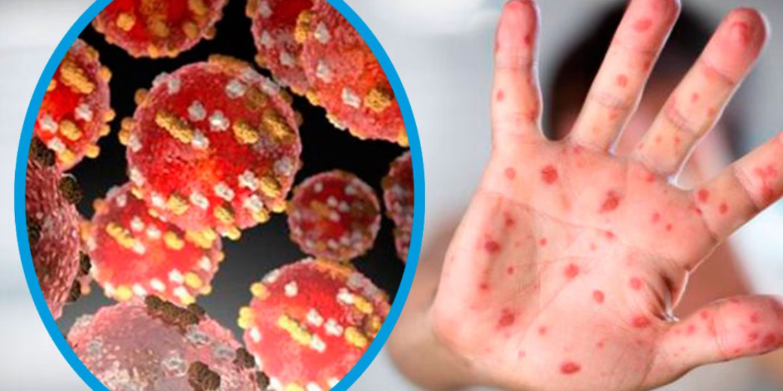 Virus del Mono, enfermedad que se transmite a los humanos. – Medical ...