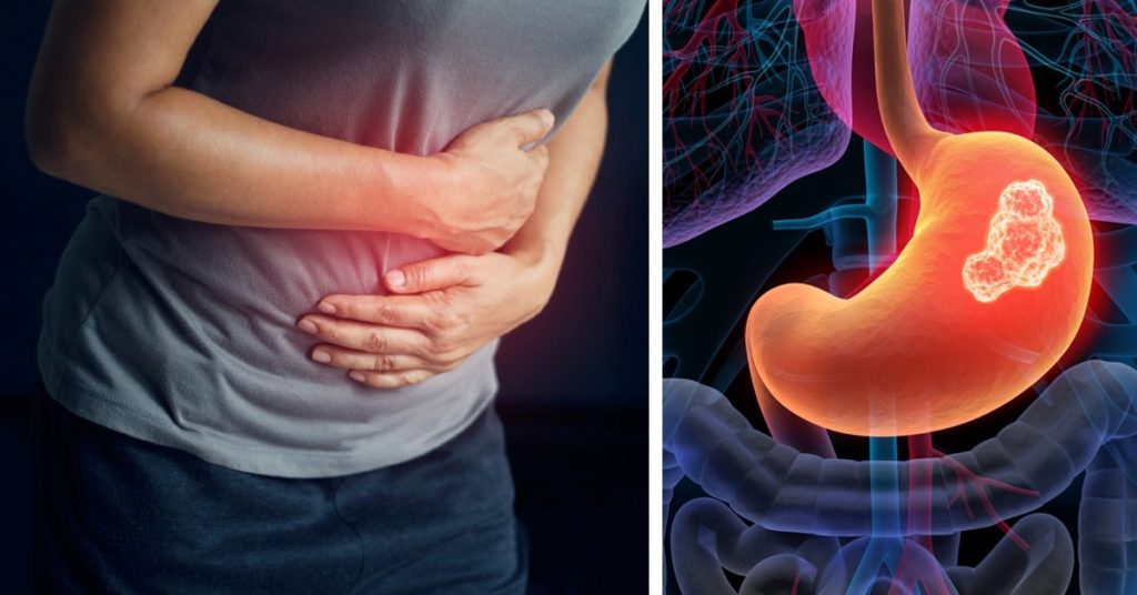 Stomach cancer – learn why chemotherapy can help you live longer ...